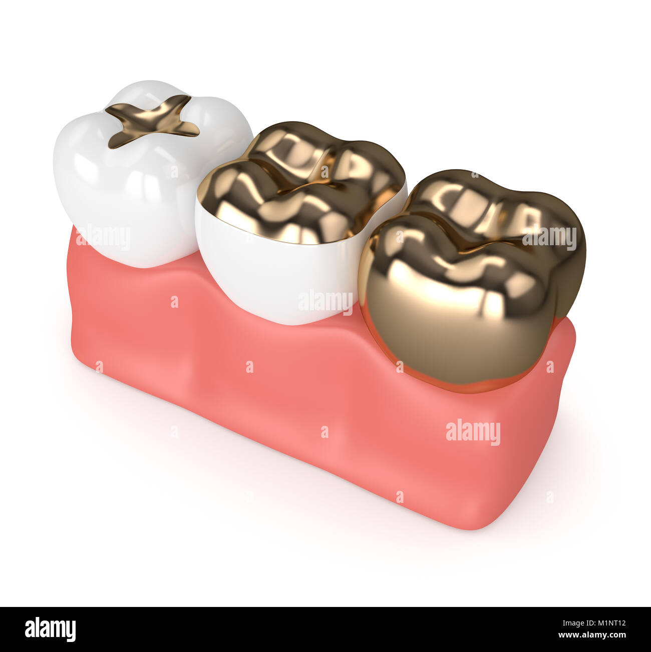 3d render of teeth with inlay, onlay and crown gold filling in gums ...