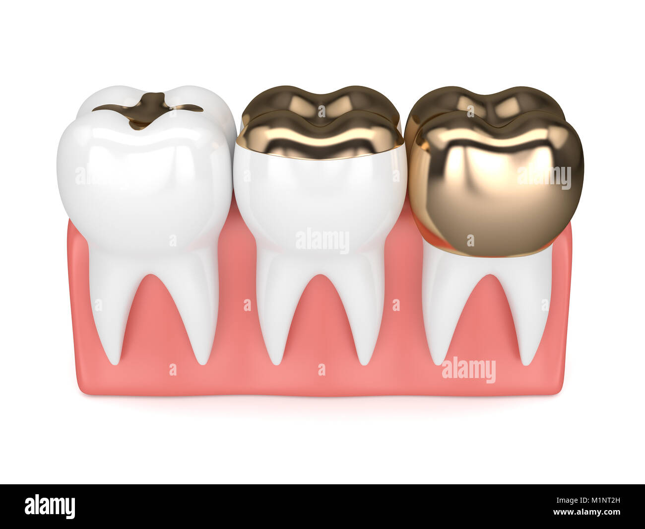 3d render of teeth with inlay, onlay and crown gold filling in gums ...