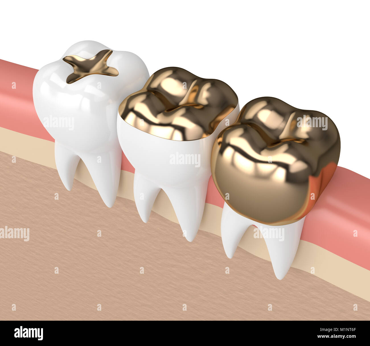 3d render of teeth with inlay, onlay and crown gold filling in gums ...