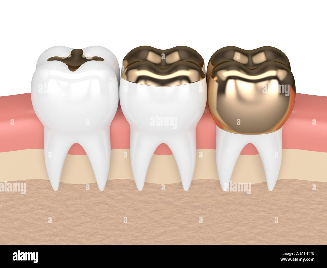 3d render of teeth with inlay, onlay and crown gold filling in gums ...