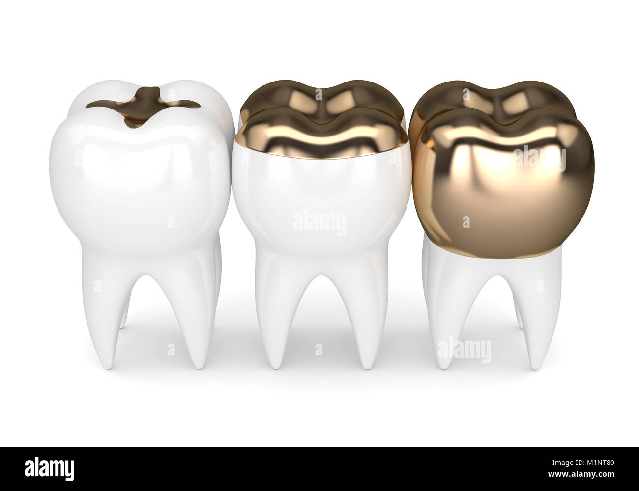 3d render of teeth with inlay, onlay and crown gold filling over white ...