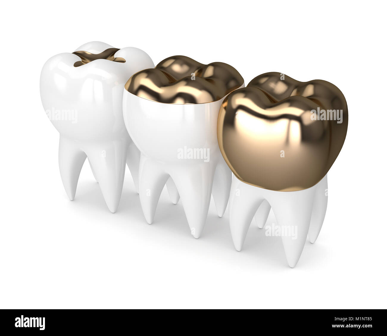 3d render of teeth with inlay, onlay and crown gold filling over white ...
