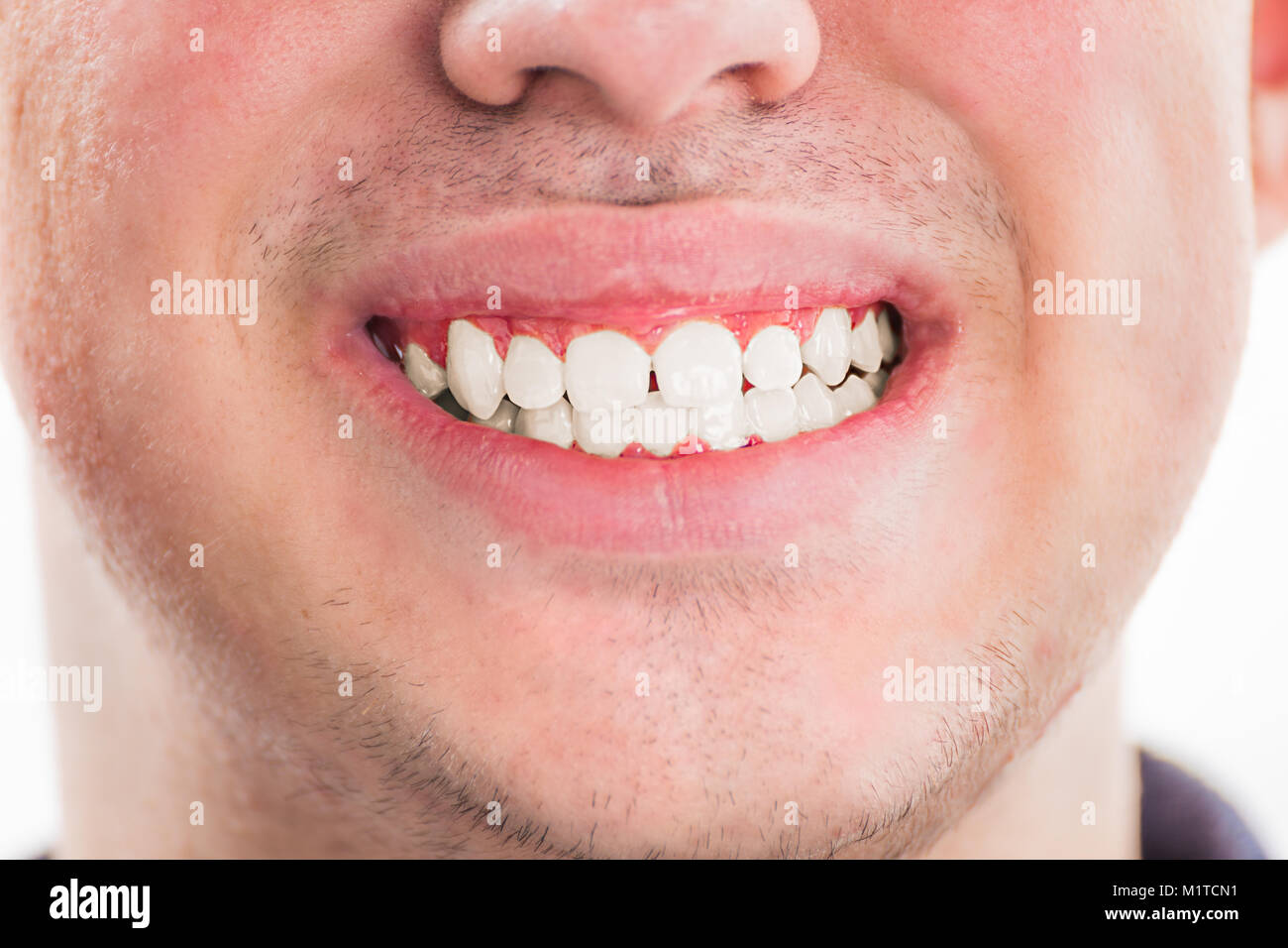 extreme closeup of white teeth of teenage boy Stock Photo - Alamy