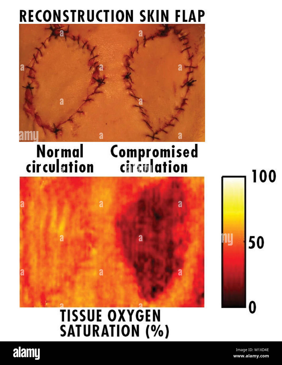 SFDI surgical camera images show reconstruction skin flaps with normal ...