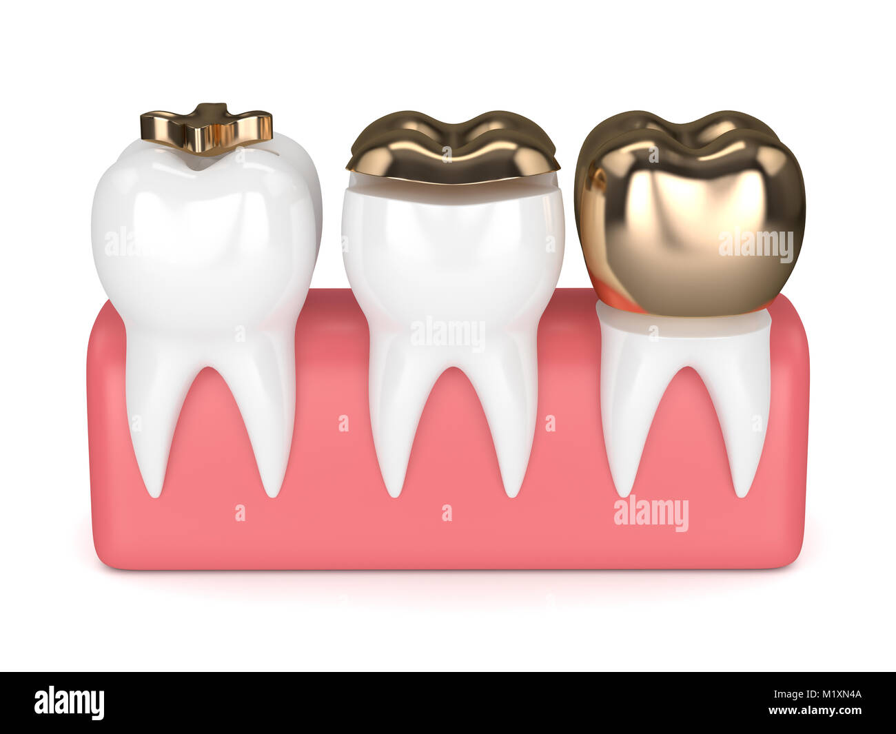 3d render of teeth with inlay, onlay and crown gold filling in gums ...