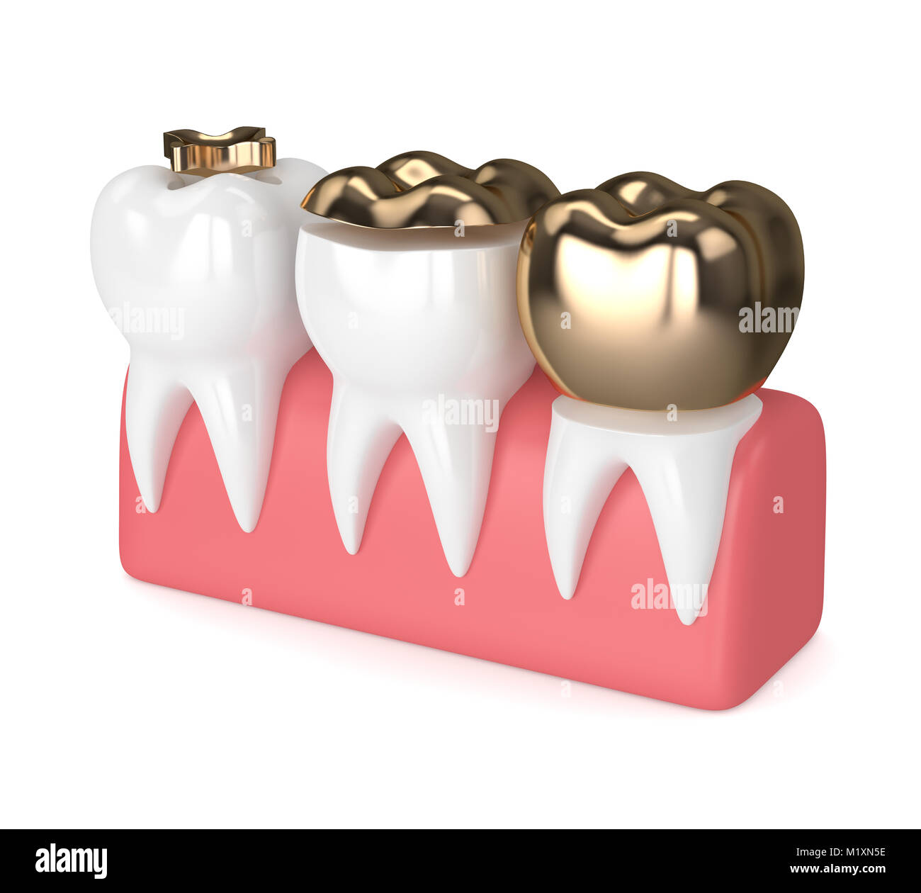 3d render of teeth with inlay, onlay and crown gold filling in gums ...
