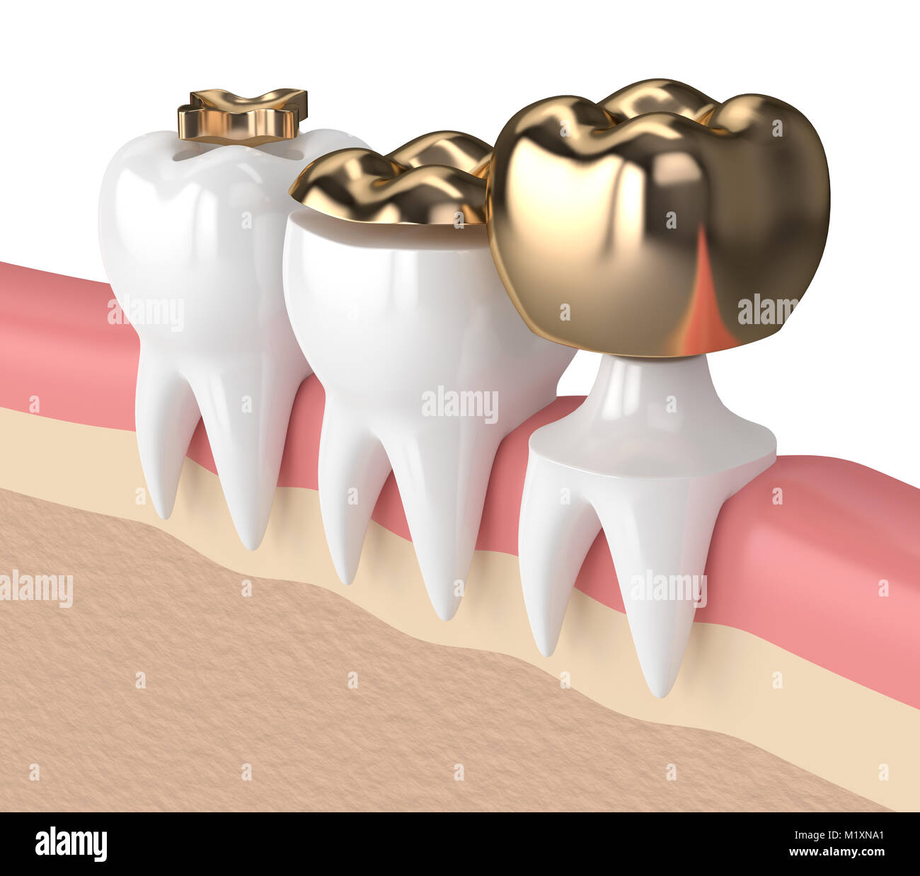 3d render of teeth with inlay, onlay and crown gold filling in gums ...
