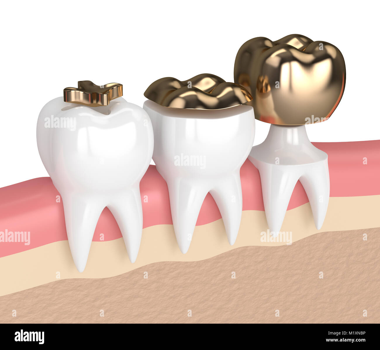 3d render of teeth with inlay, onlay and crown gold filling in gums ...