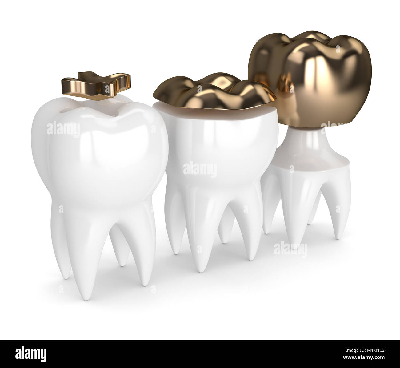 3d render of teeth with inlay, onlay and crown gold filling over white ...