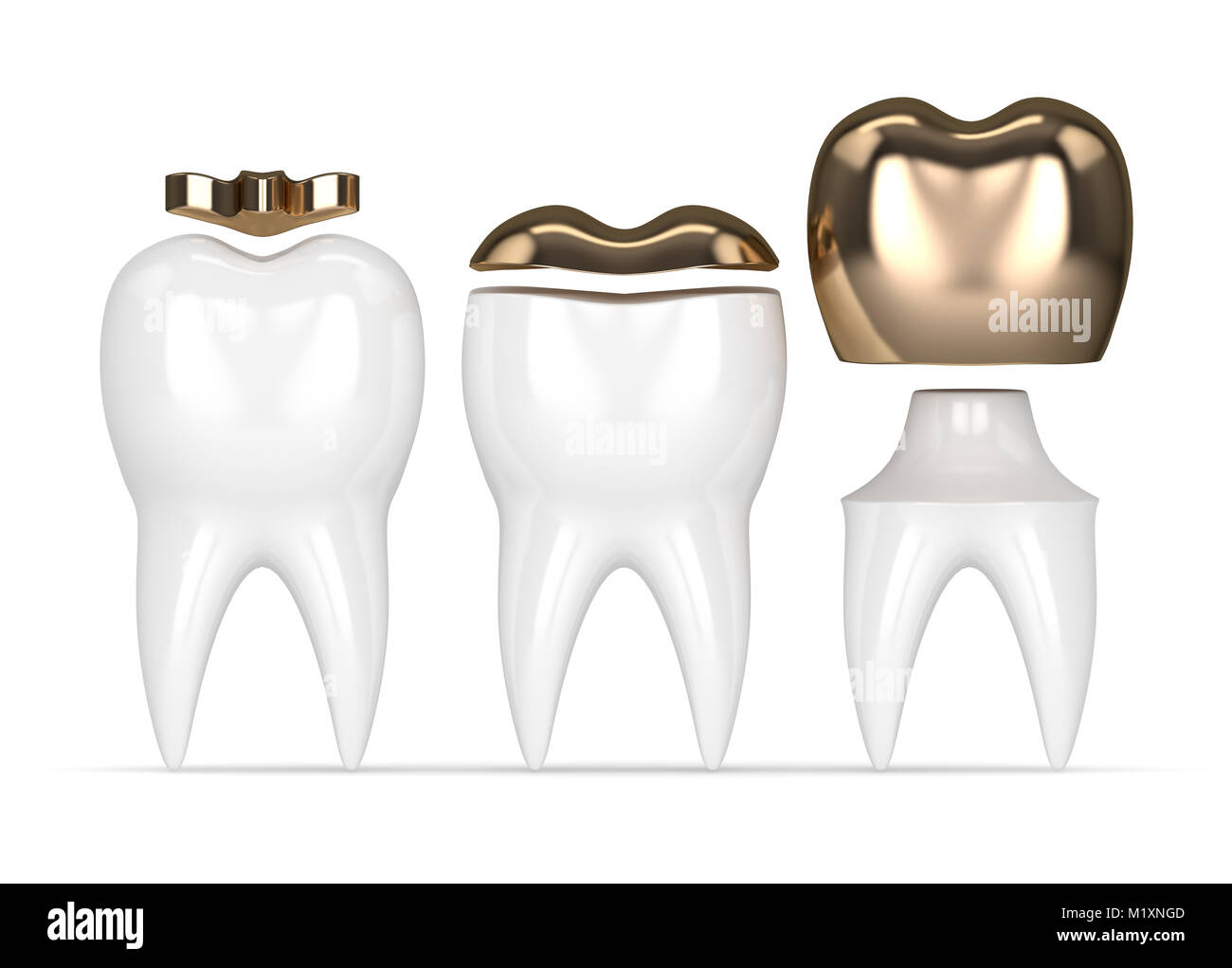 3d render of teeth with inlay, onlay and crown gold filling over white ...