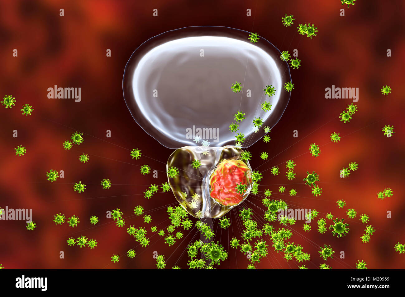 Cancer prostate adenocarcinoma High Resolution Stock Photography and ...