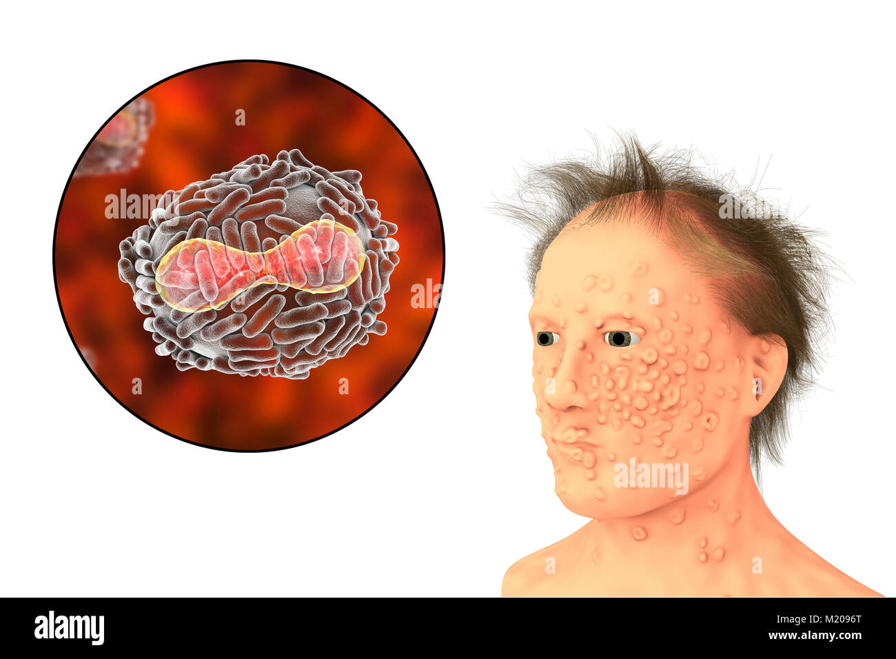 Smallpox rash hi-res stock photography and images - Alamy