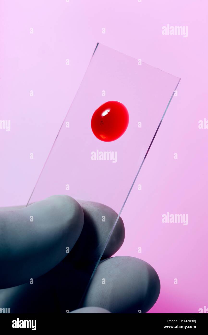 MODEL RELEASED. Blood sample on microscope slide, studio shot Stock ...