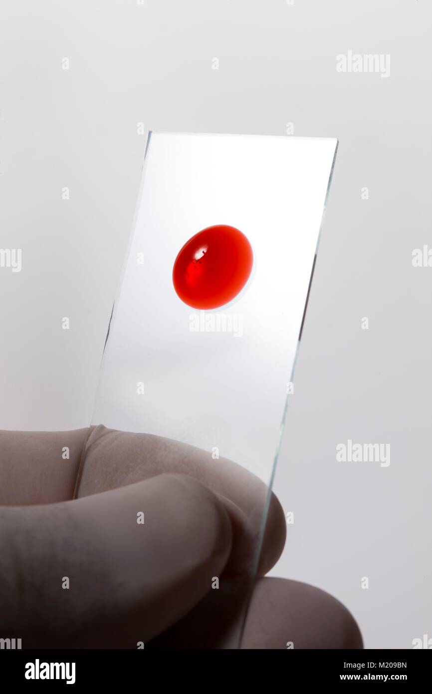 MODEL RELEASED. Blood sample on microscope slide, studio shot Stock ...