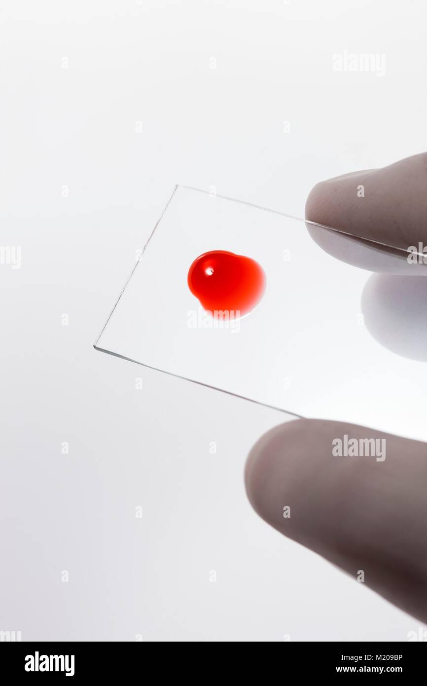 MODEL RELEASED. Blood sample on microscope slide, studio shot Stock ...