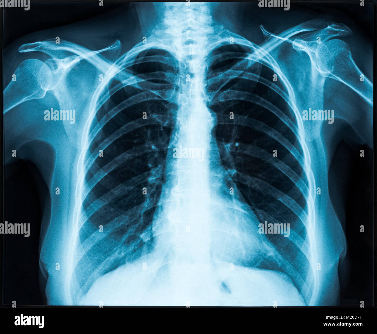 Woman thorax x-ray for lungs examination Stock Photo - Alamy
