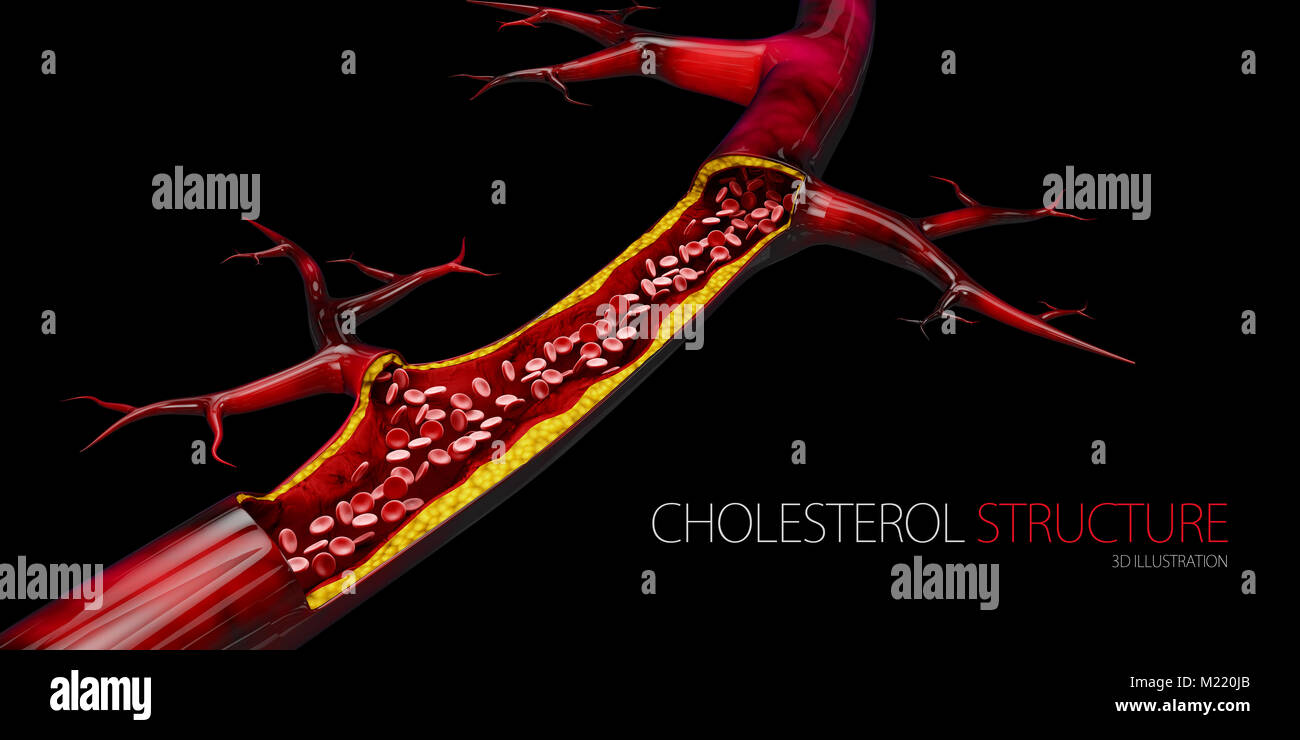 Blocked blood vessel - artery with cholesterol buildup realistic 3d ...