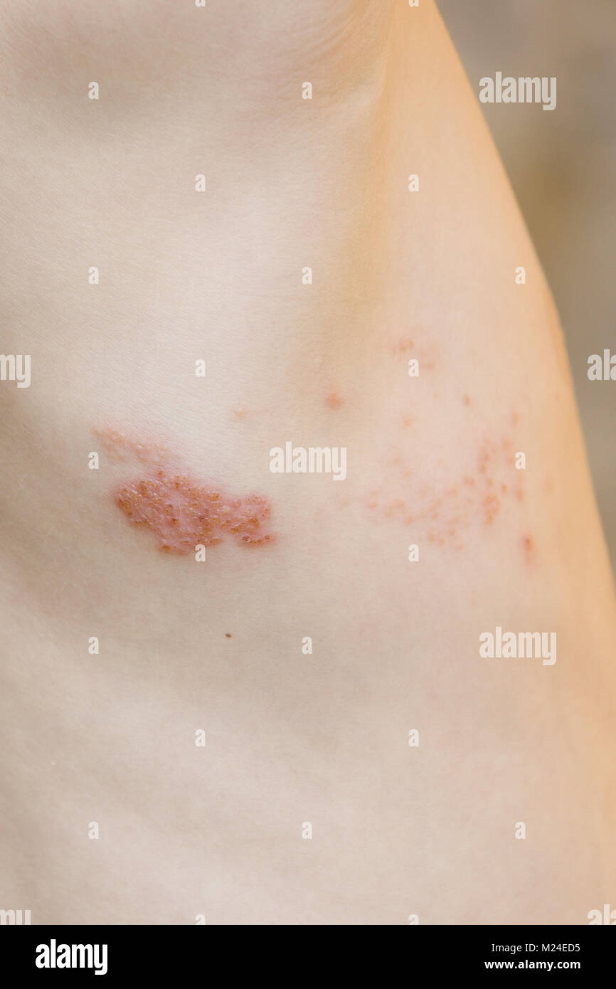 Herpes varicella zoster hi-res stock photography and images - Alamy