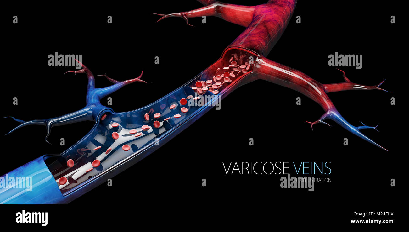 Venous Leg Ulcer High Resolution Stock Photography and Images - Alamy