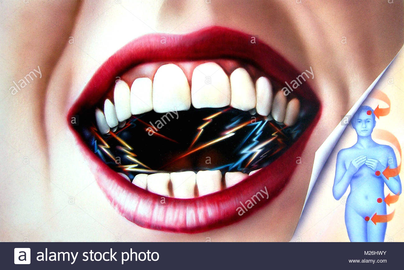 Amalgam Fillings Stock Photos & Amalgam Fillings Stock Images - Alamy