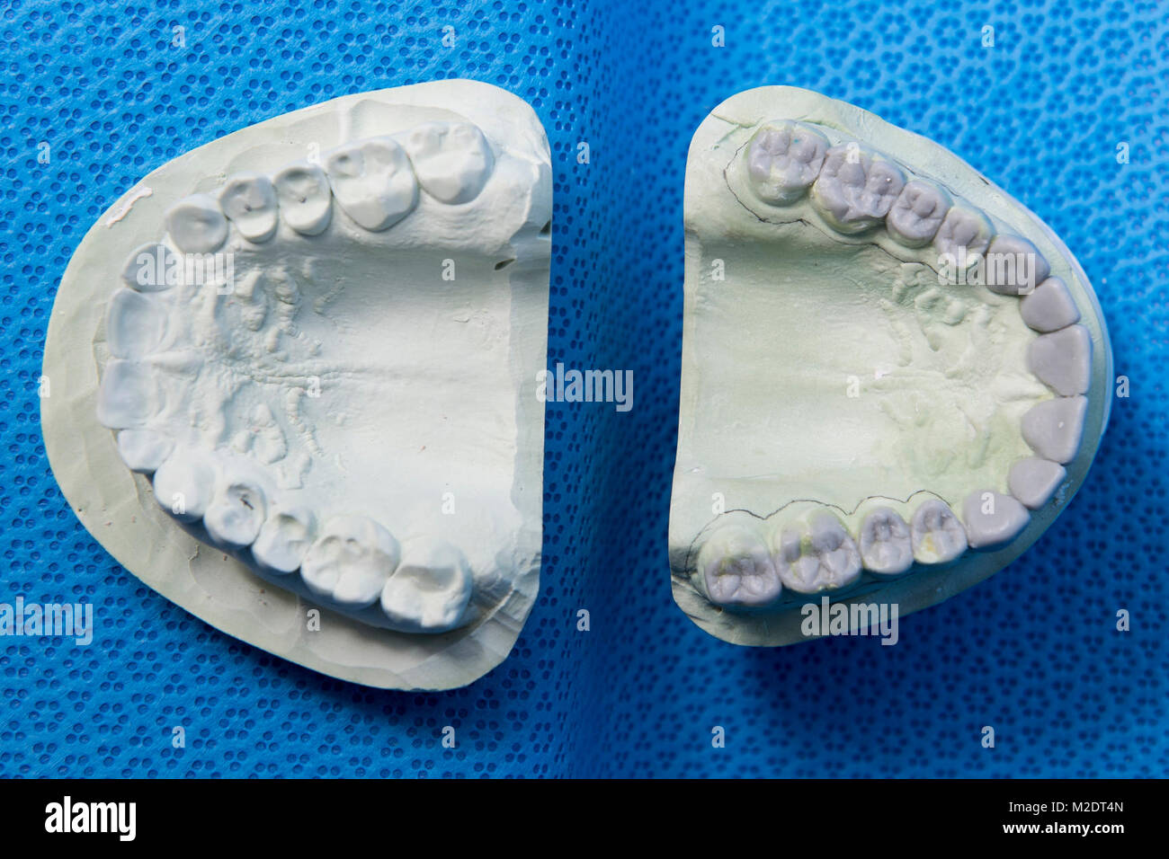 A mold of the original top row of teeth, (left), sits for comparison ...