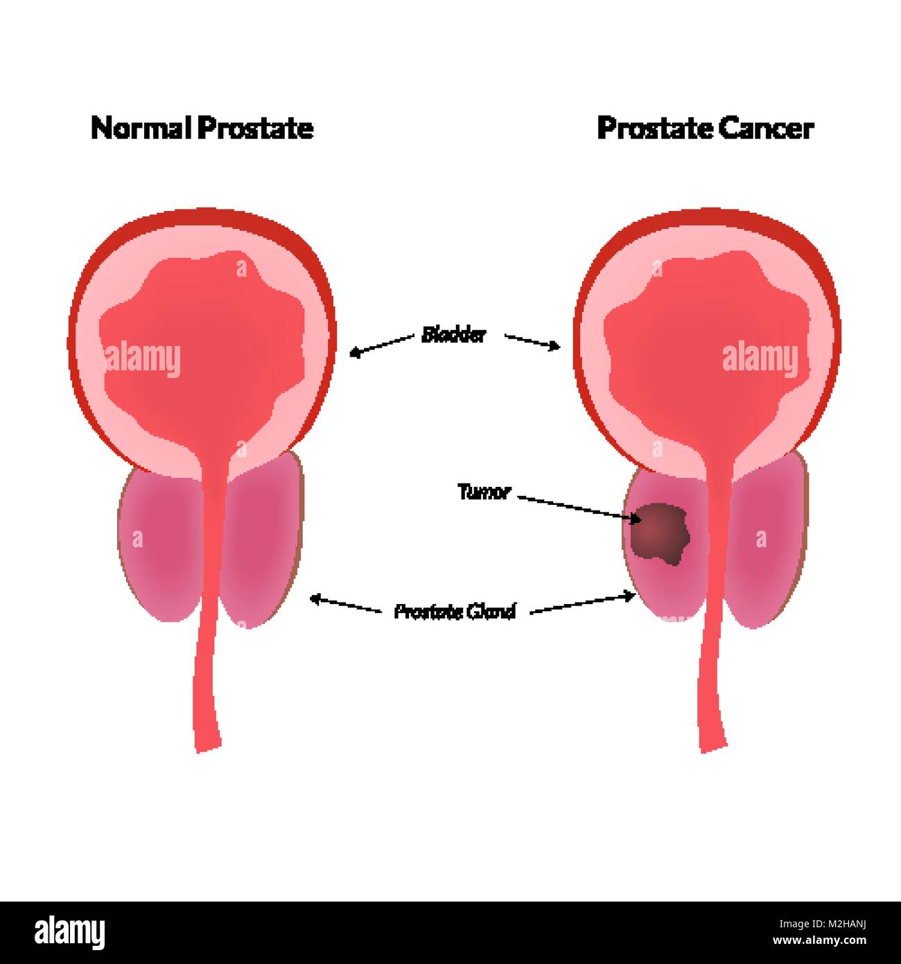 Tumor in prostate gland is a common cancer harbinger Stock Vector Image ...