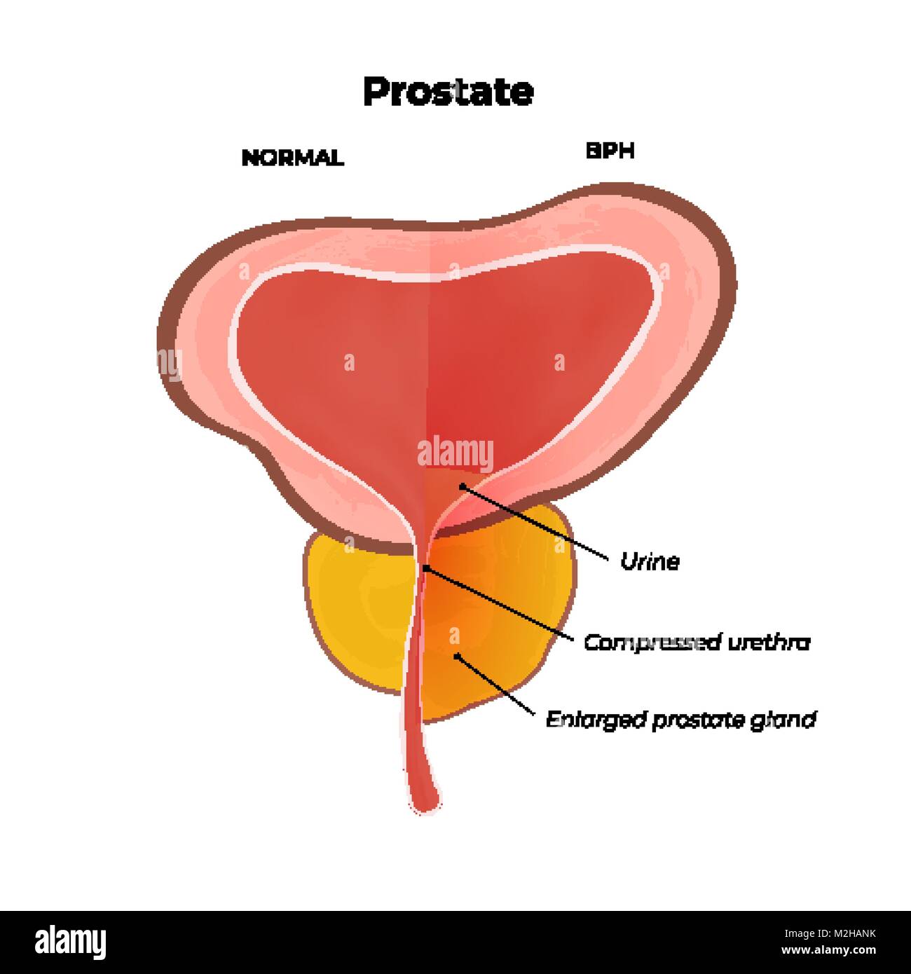 BPH infographics. Prostatic hyperplasia. Normal and inflamed prostate ...