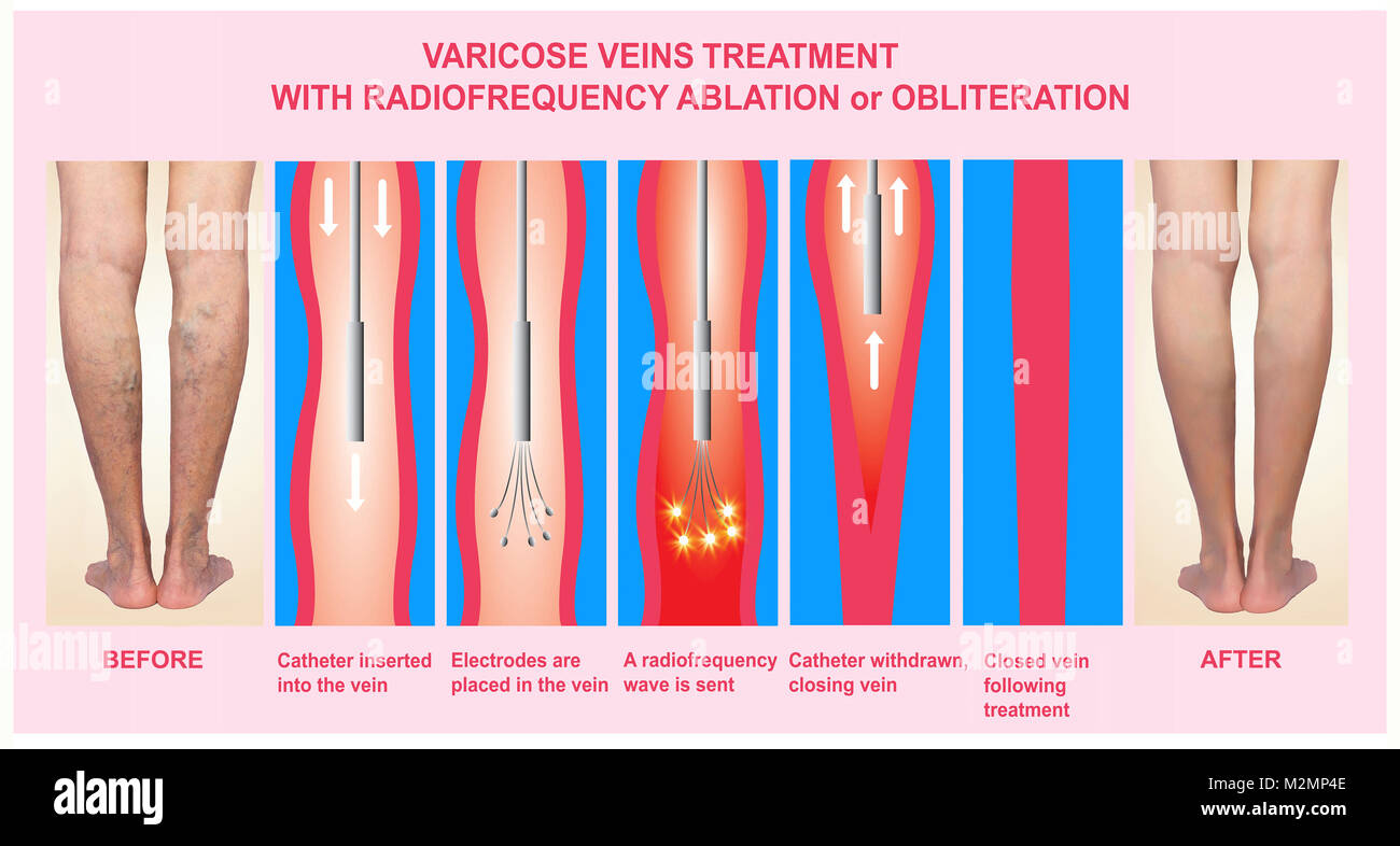 Varicose Veins and Treatment with radiofrequency ablation Stock Photo ...