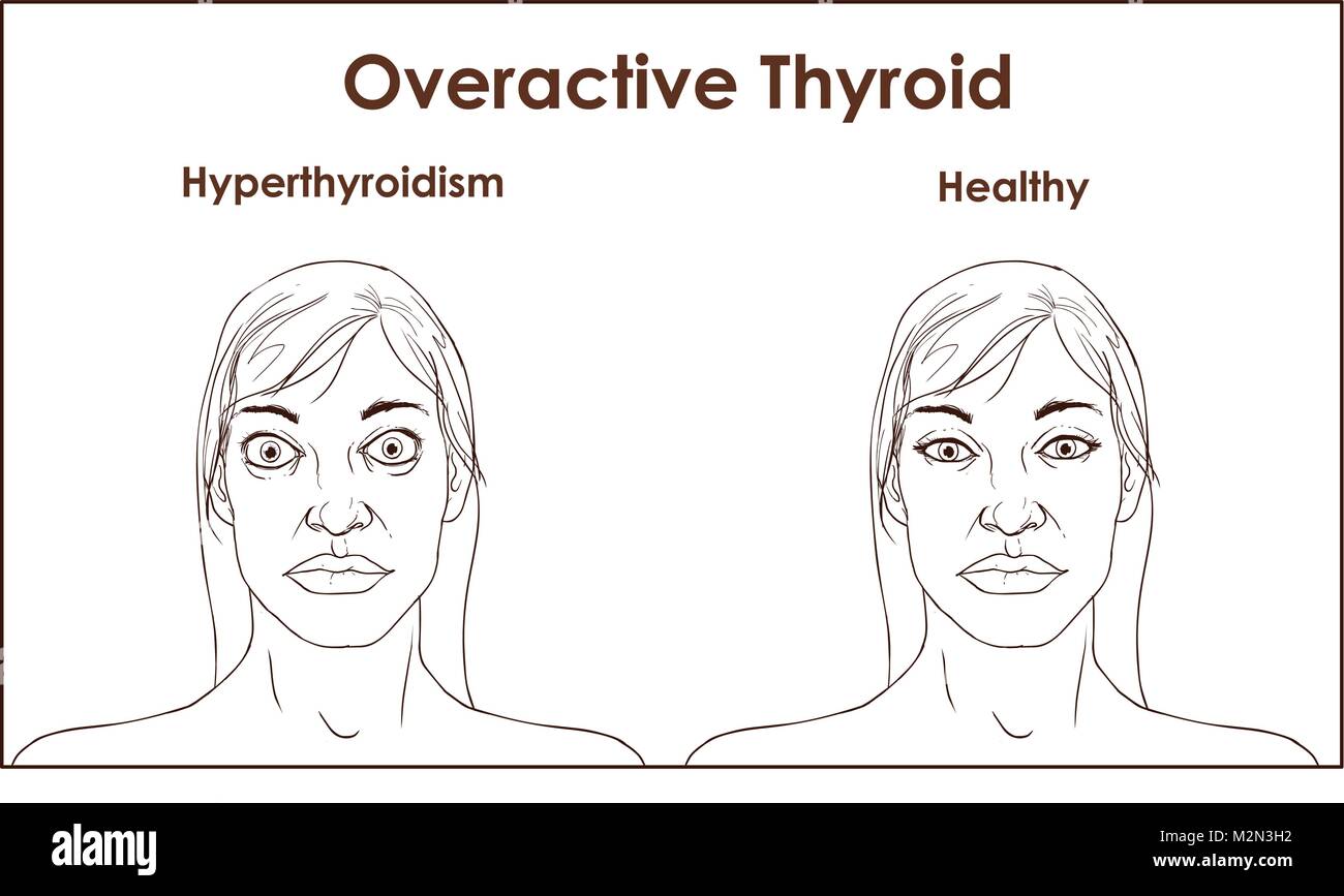 Face of an adult female exhibiting the symptoms of hyperthyroidism ...