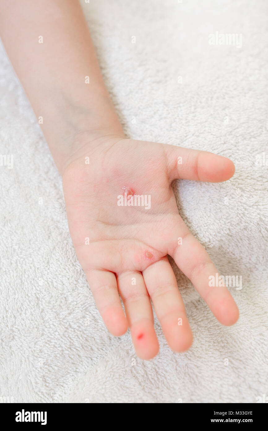 Hand Blisters Child