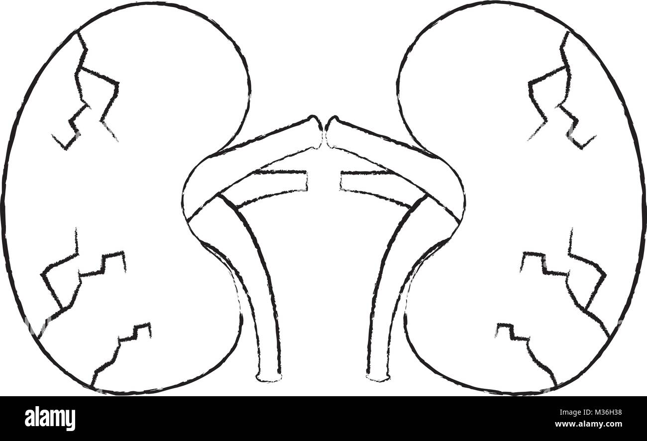 kidneys human unhealthy disease medical anatomic damaged Stock Vector ...