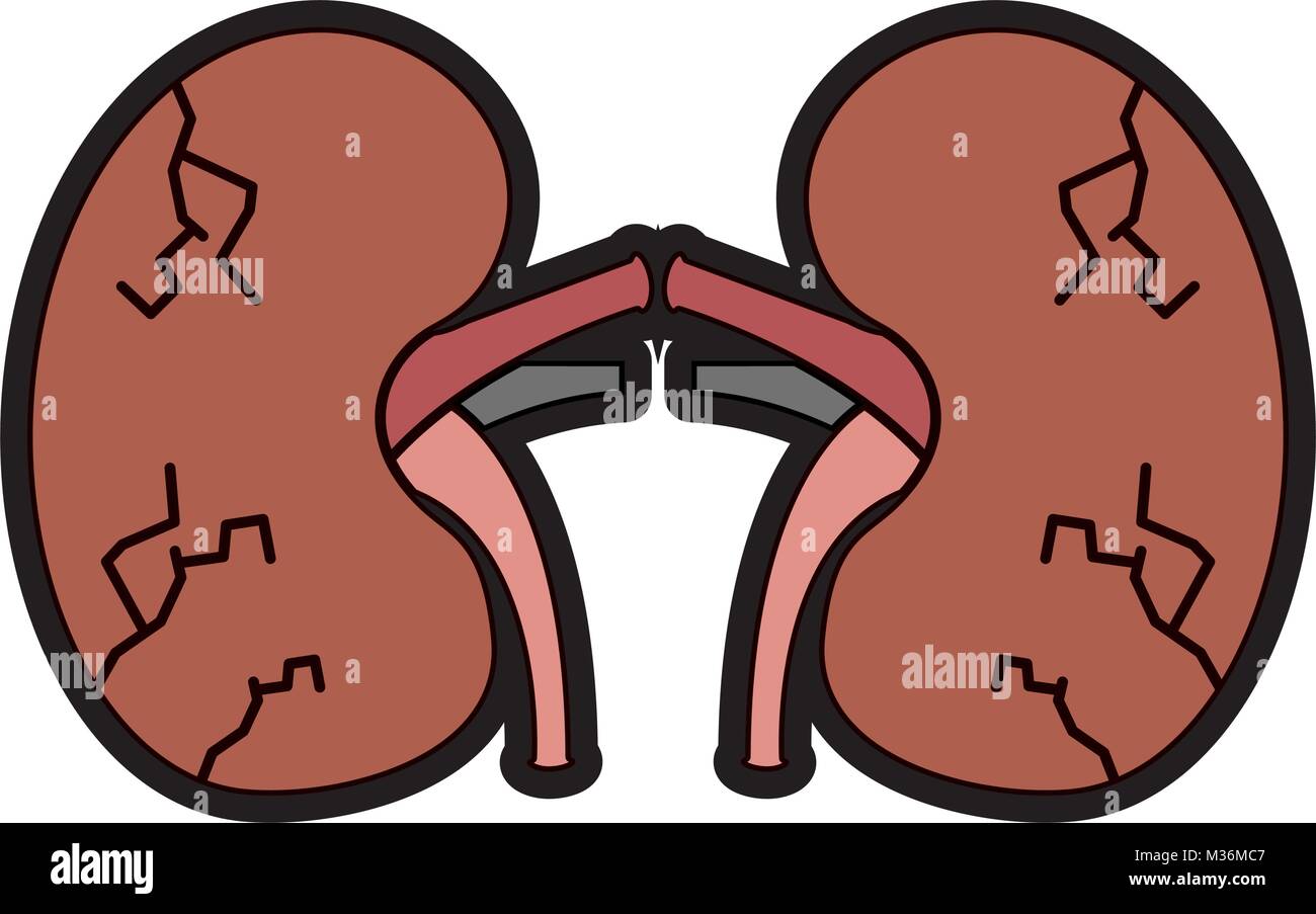 kidneys human unhealthy disease medical anatomic damaged Stock Vector ...