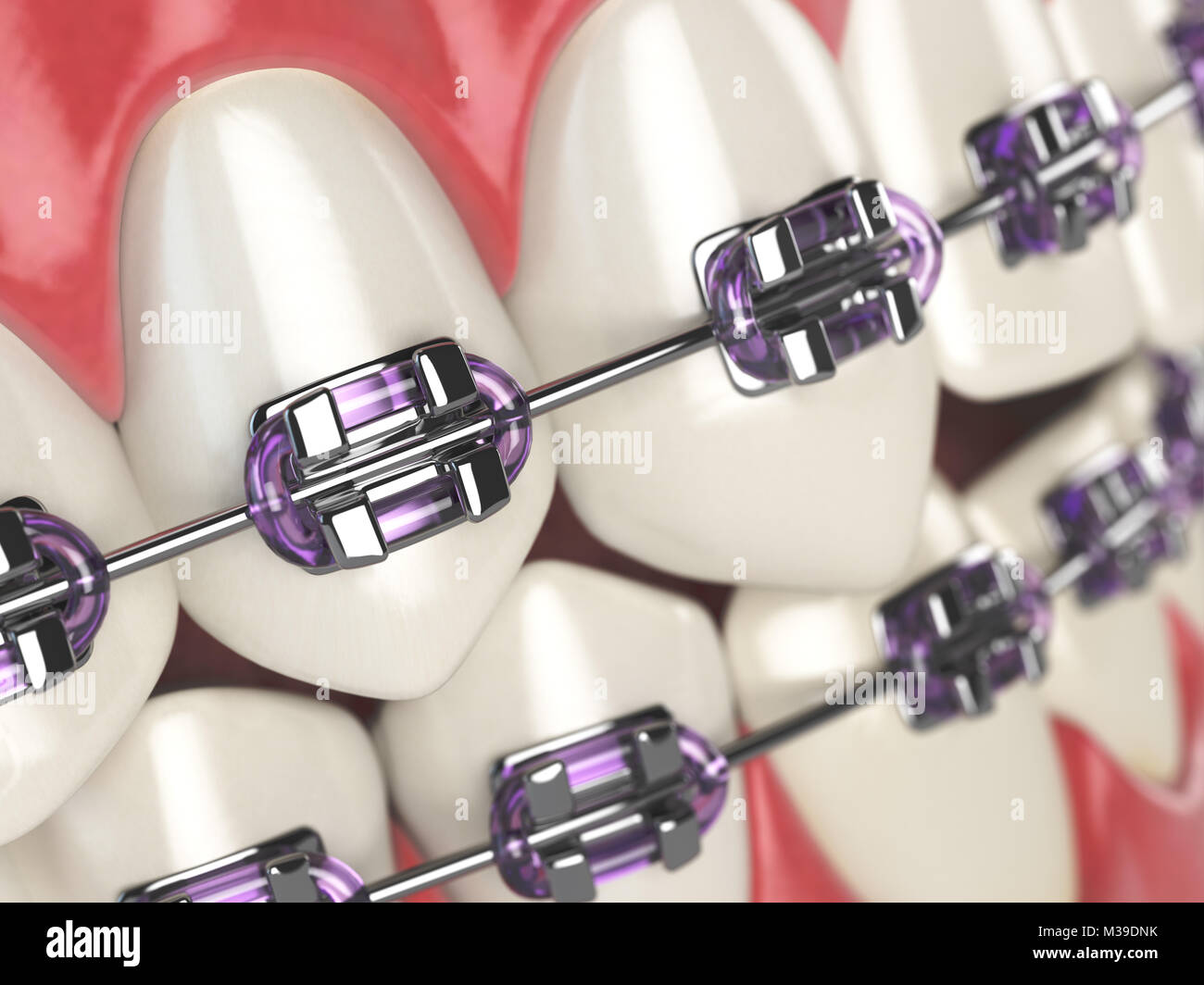 Teeth with braces or brackets in open human mouth. Dental care concept ...