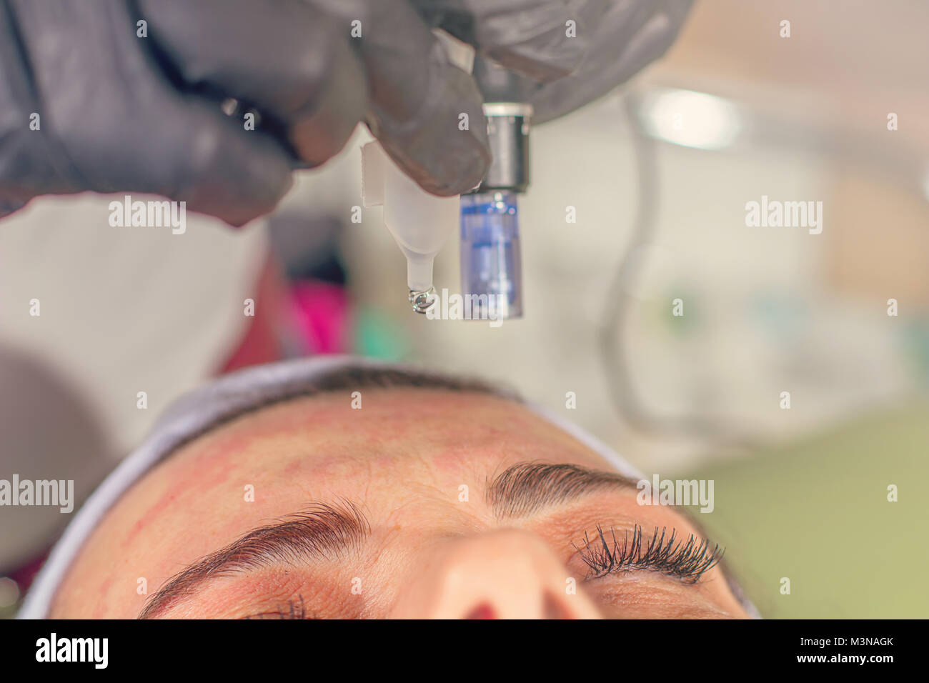 Needle mesotherapy treatment on a woman face Stock Photo - Alamy