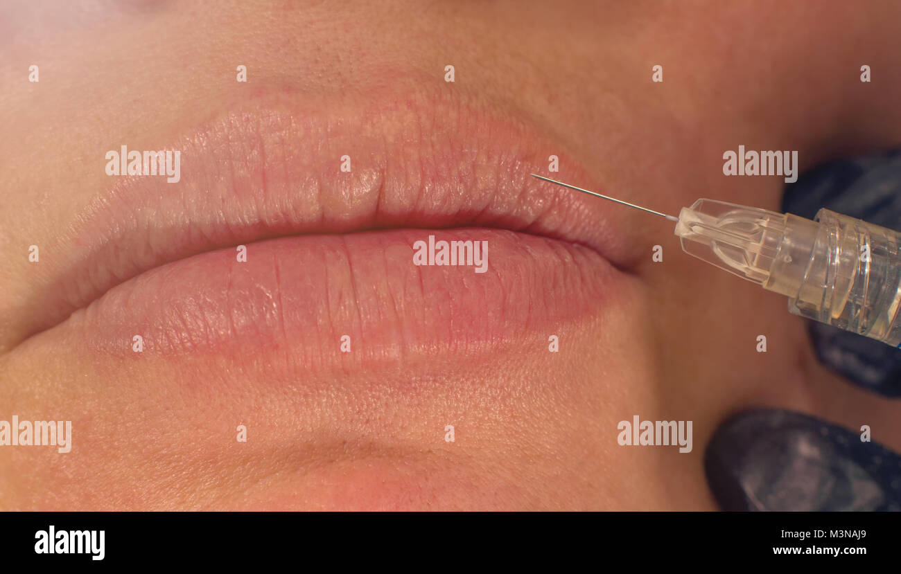 Beauty injections Close Up. Lip filler injection Stock Photo - Alamy