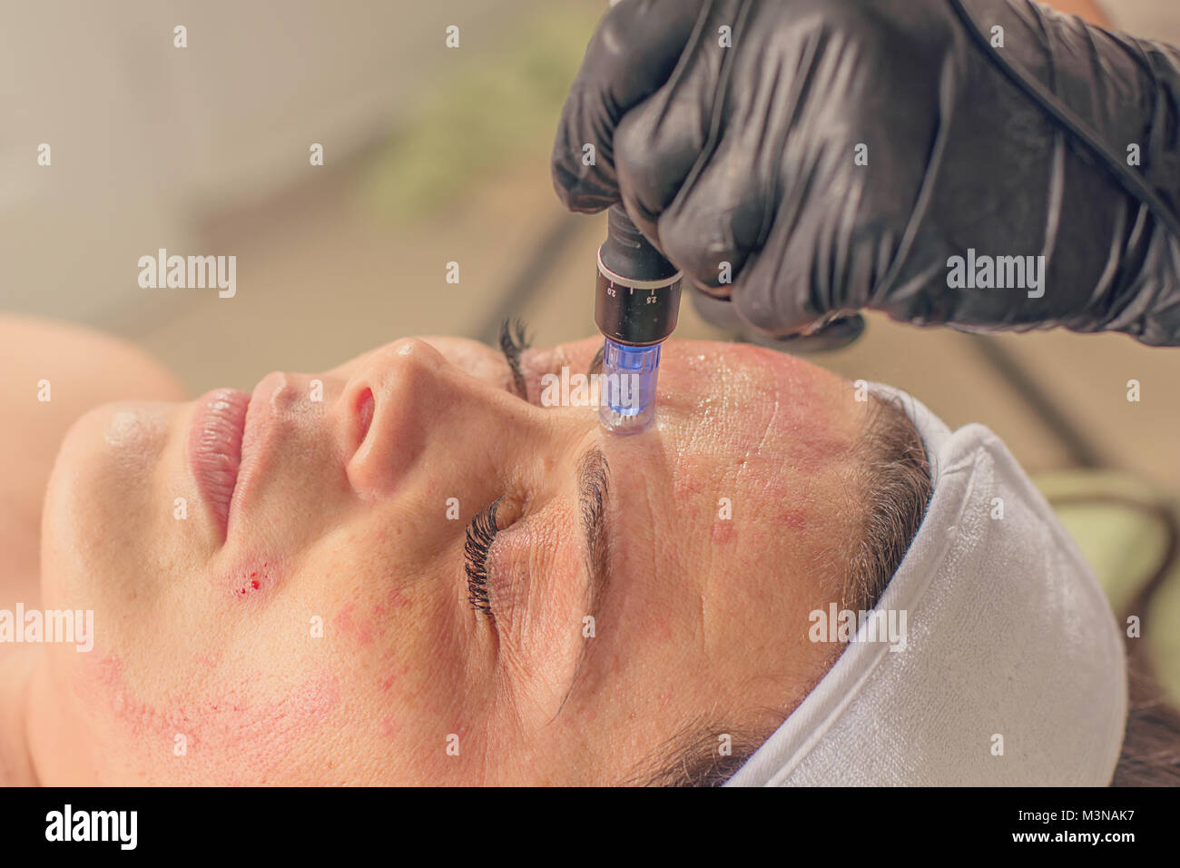 Needle mesotherapy treatment on a woman face Stock Photo - Alamy