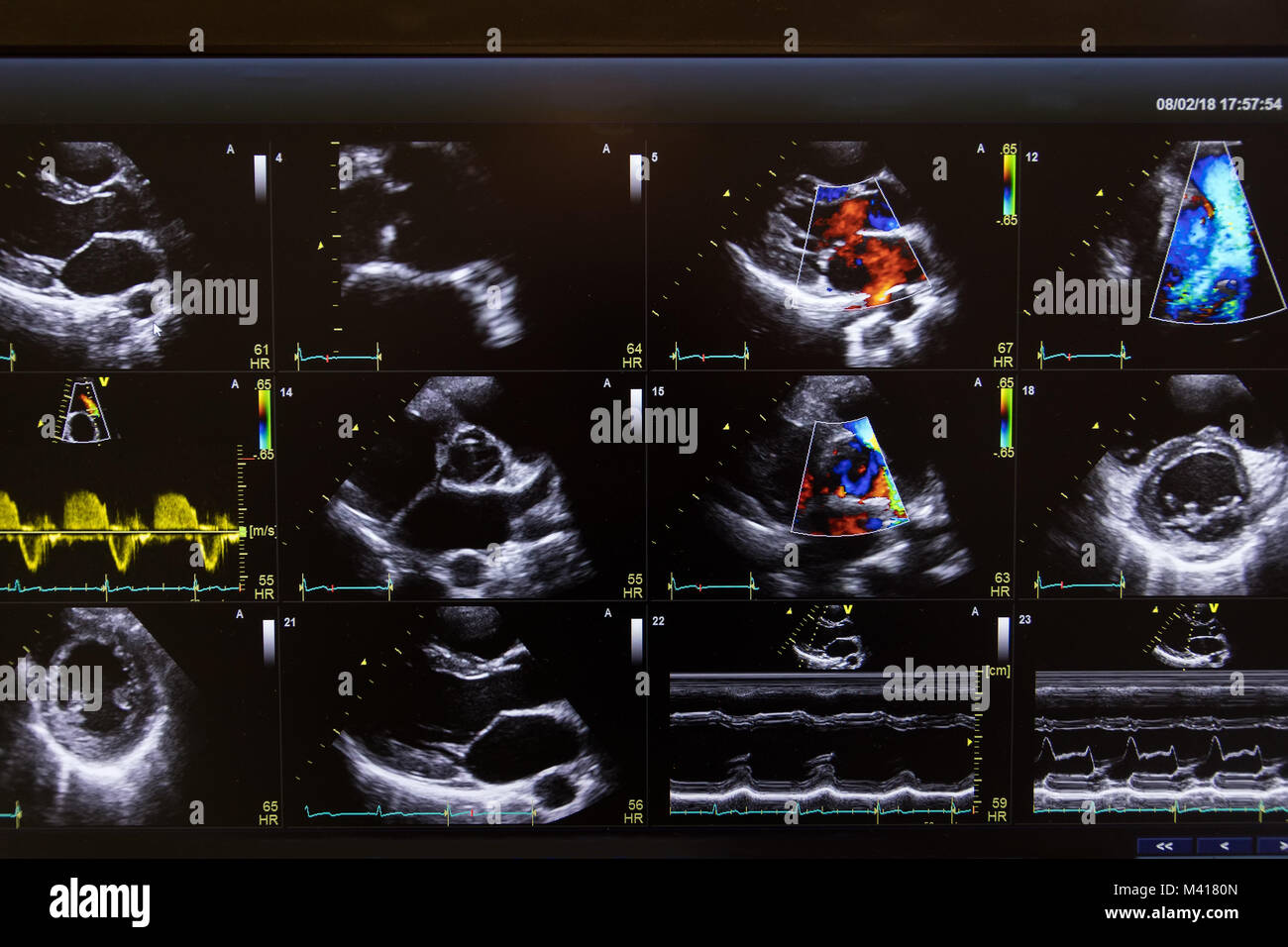 Heart ultrasound image on a computer screen Stock Photo - Alamy
