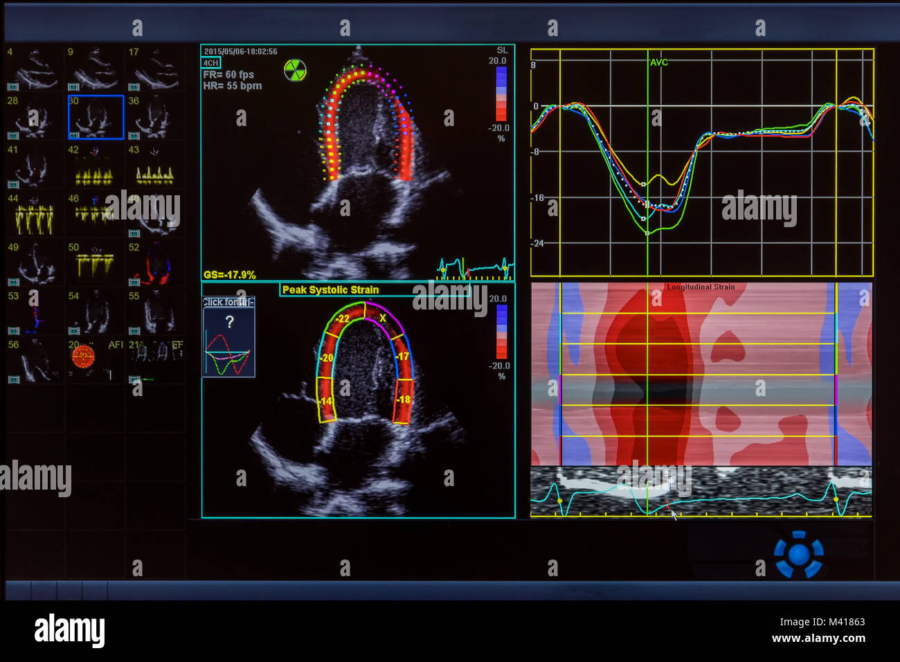 Heart ultrasound image on a computer screen Stock Photo - Alamy