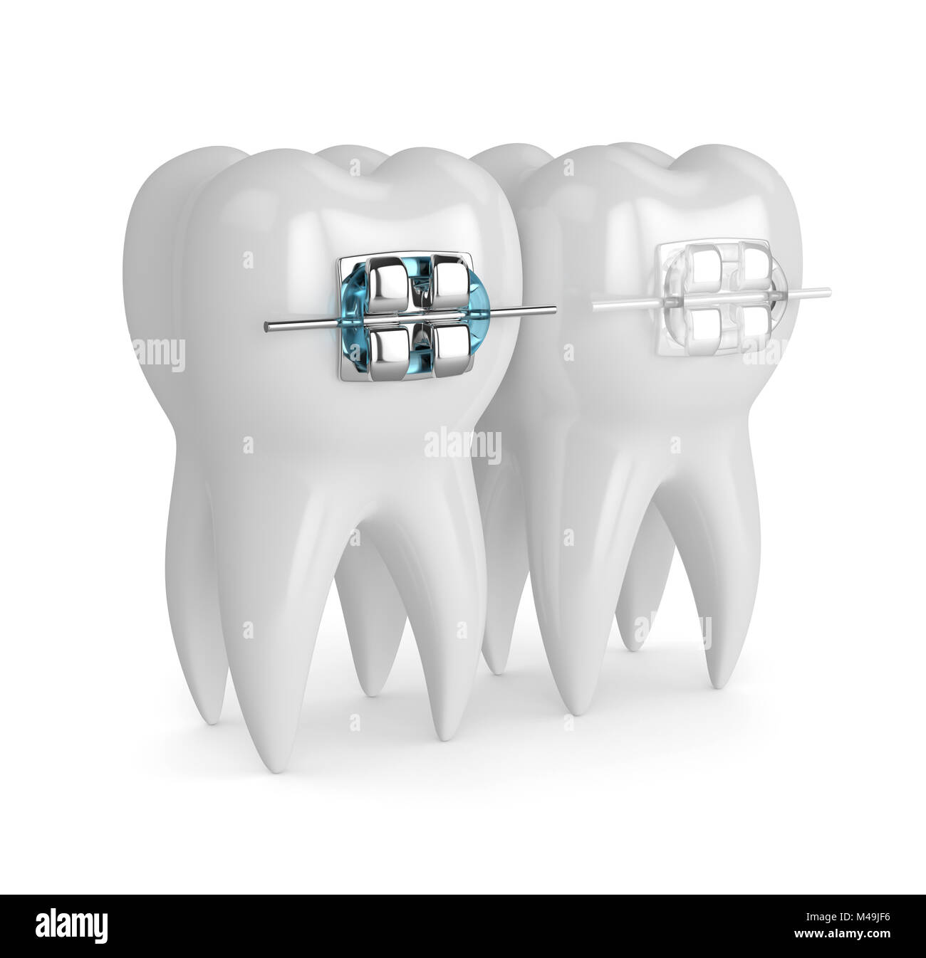 3d render of teeth with ceramic and metal braces isolated over white ...