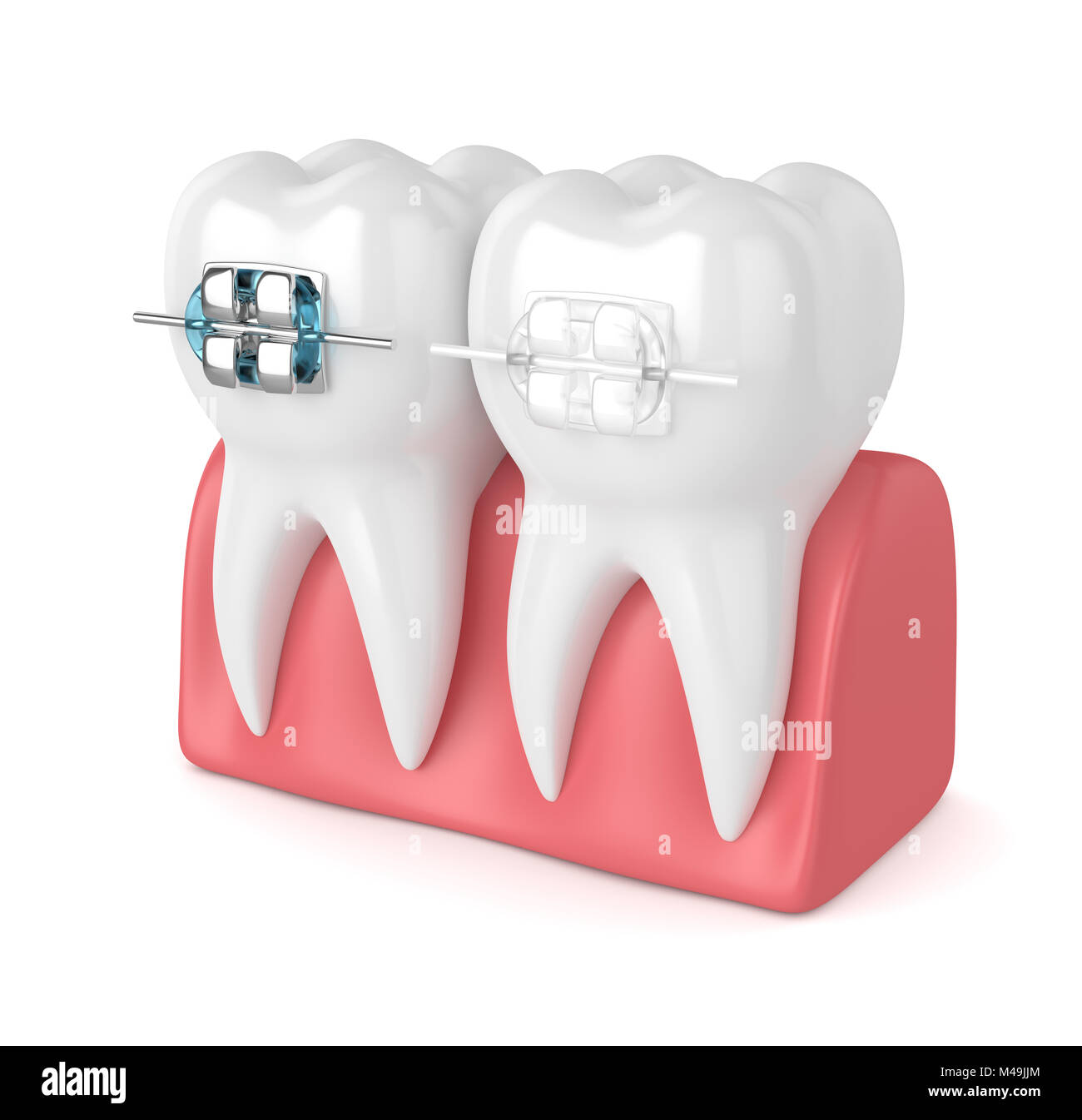 3d render of teeth with ceramic and metal braces in gums isolated over ...
