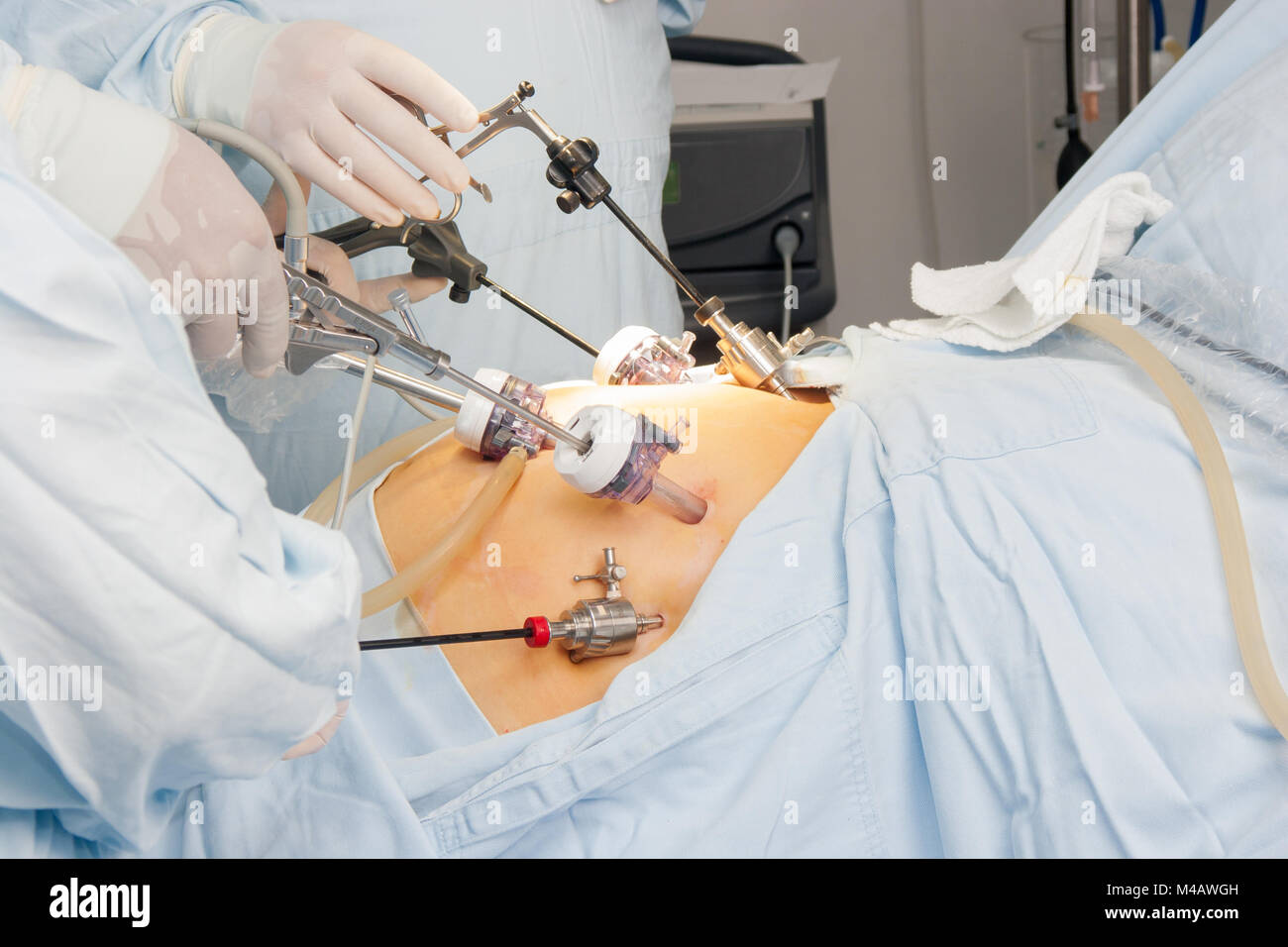 Portrait of gastric bypass surgery in hospital Stock Photo - Alamy