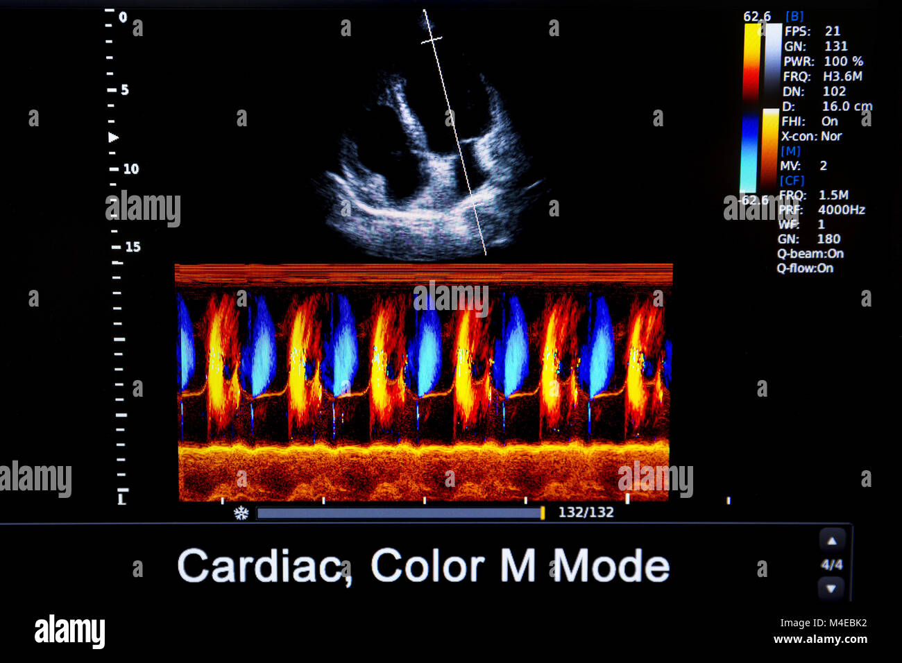 Echocardiography monitor hi-res stock photography and images - Alamy