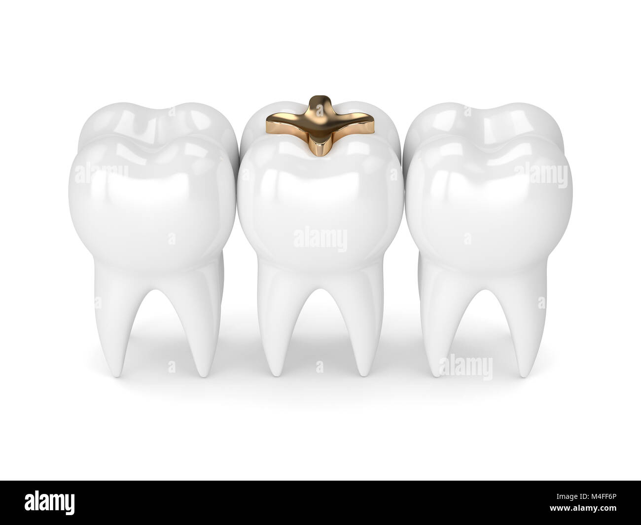 3d render of teeth with dental golden inlay filling in gums over white ...
