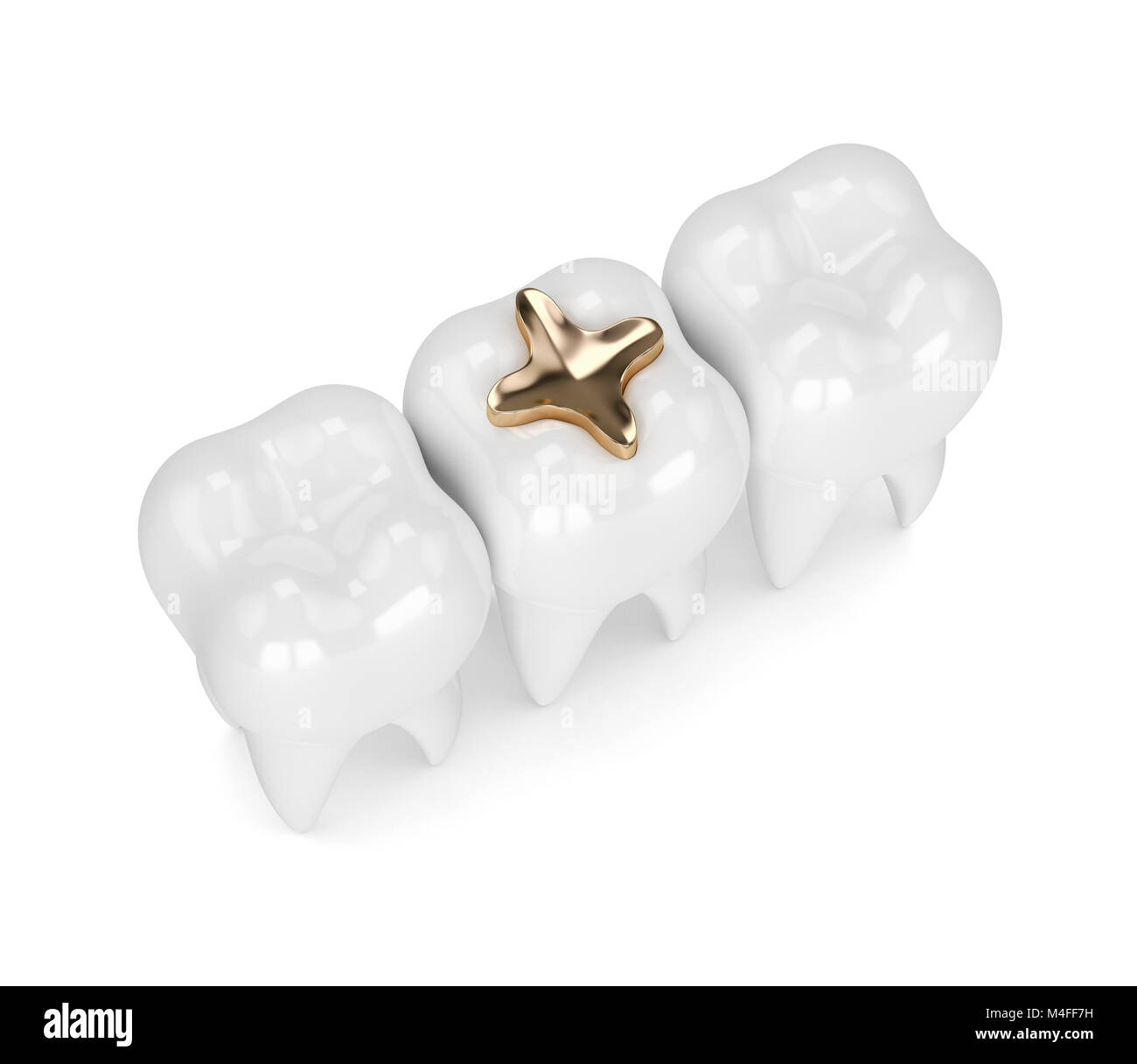 3d render of teeth with dental golden inlay filling over white ...
