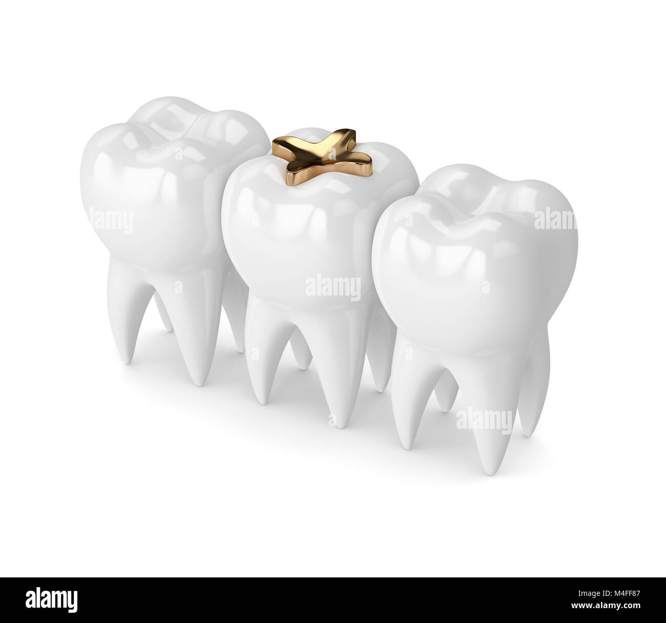 3d render of teeth with dental golden inlay filling over white ...