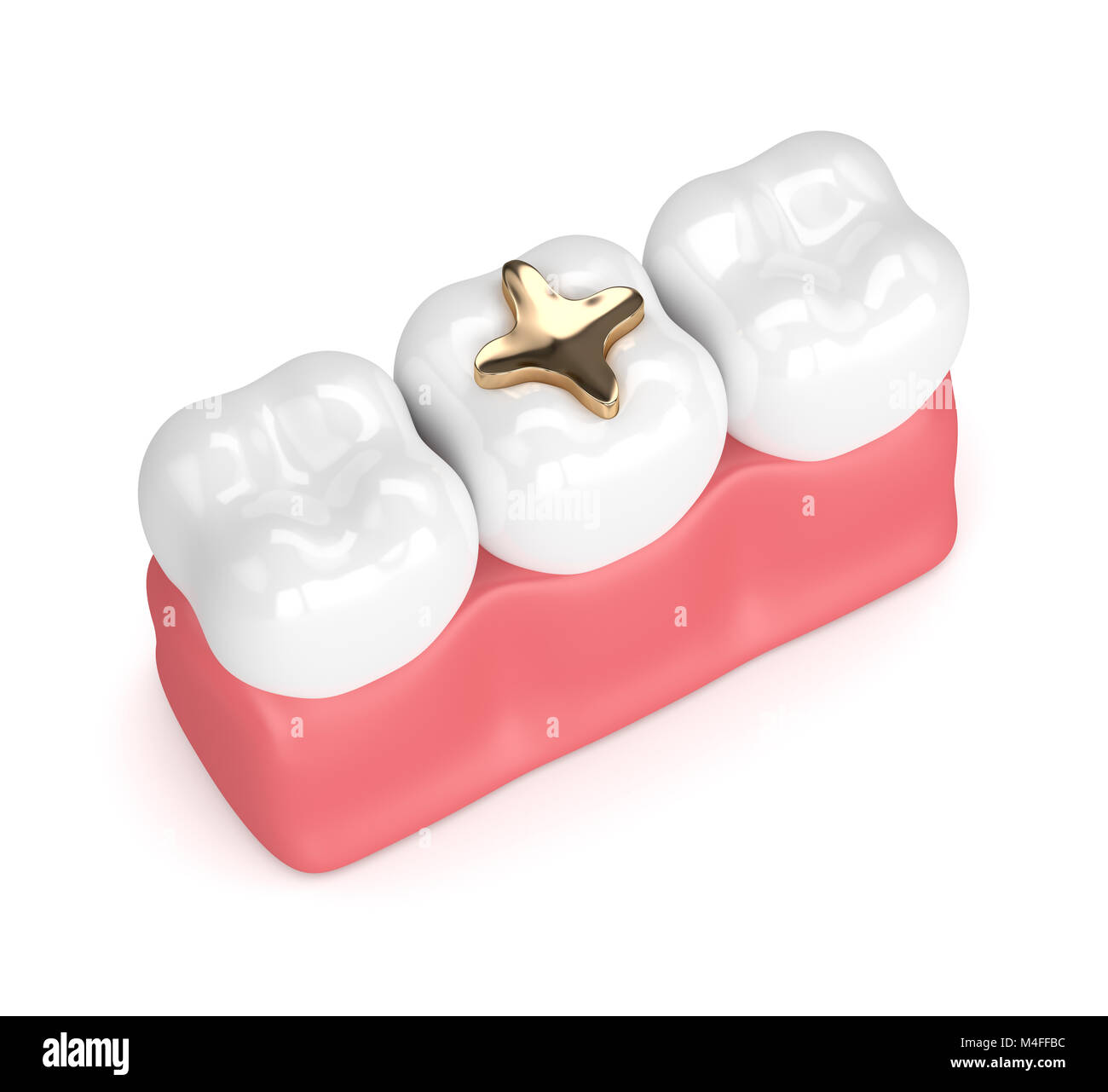 3d render of teeth with dental golden inlay filling in gums over white ...