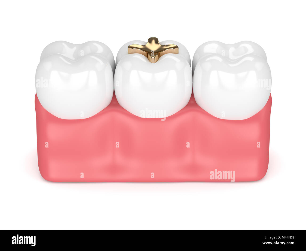 3d render of teeth with dental golden inlay filling in gums over white ...