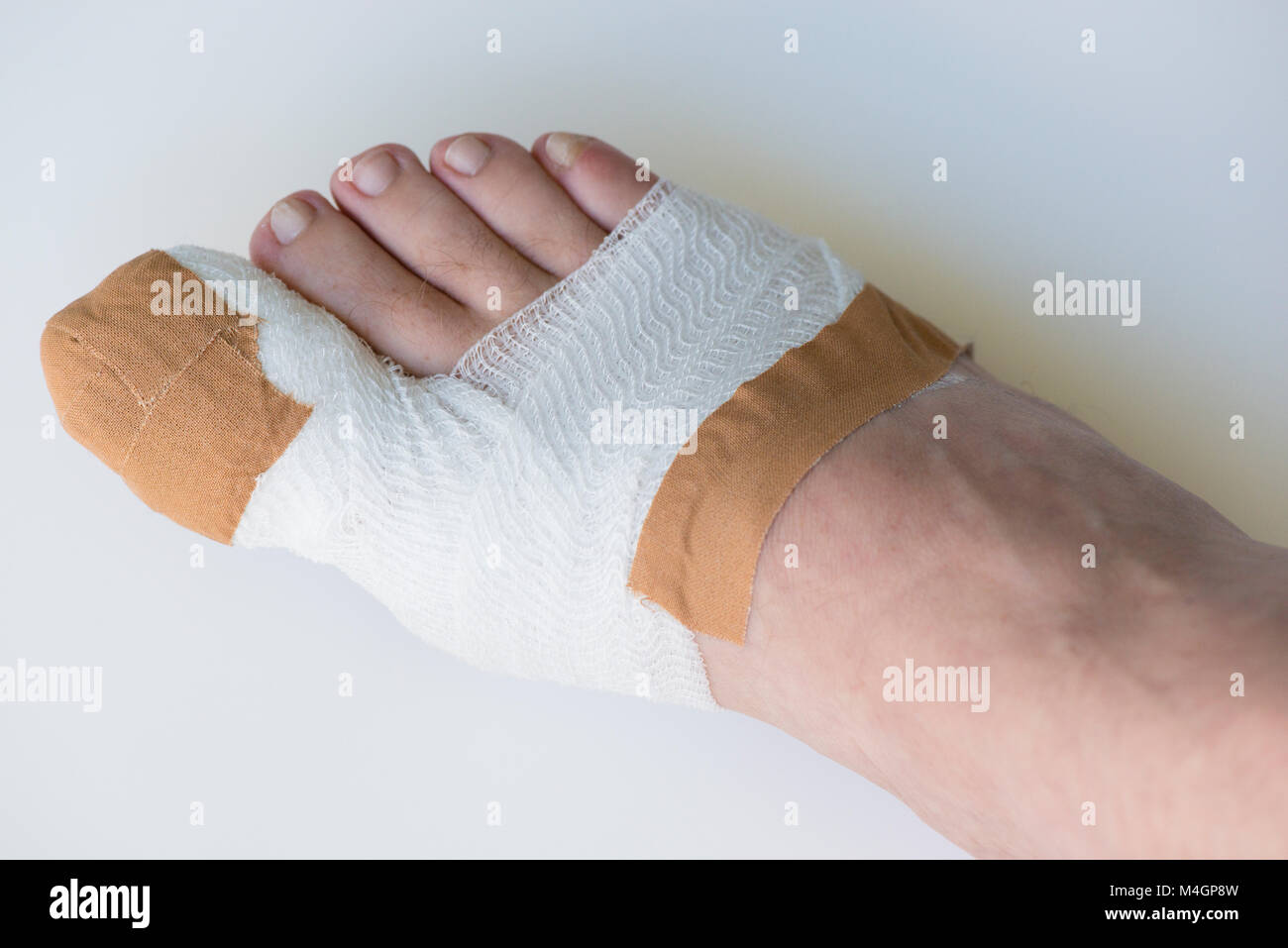 Toe operation on the big toe Stock Photo - Alamy