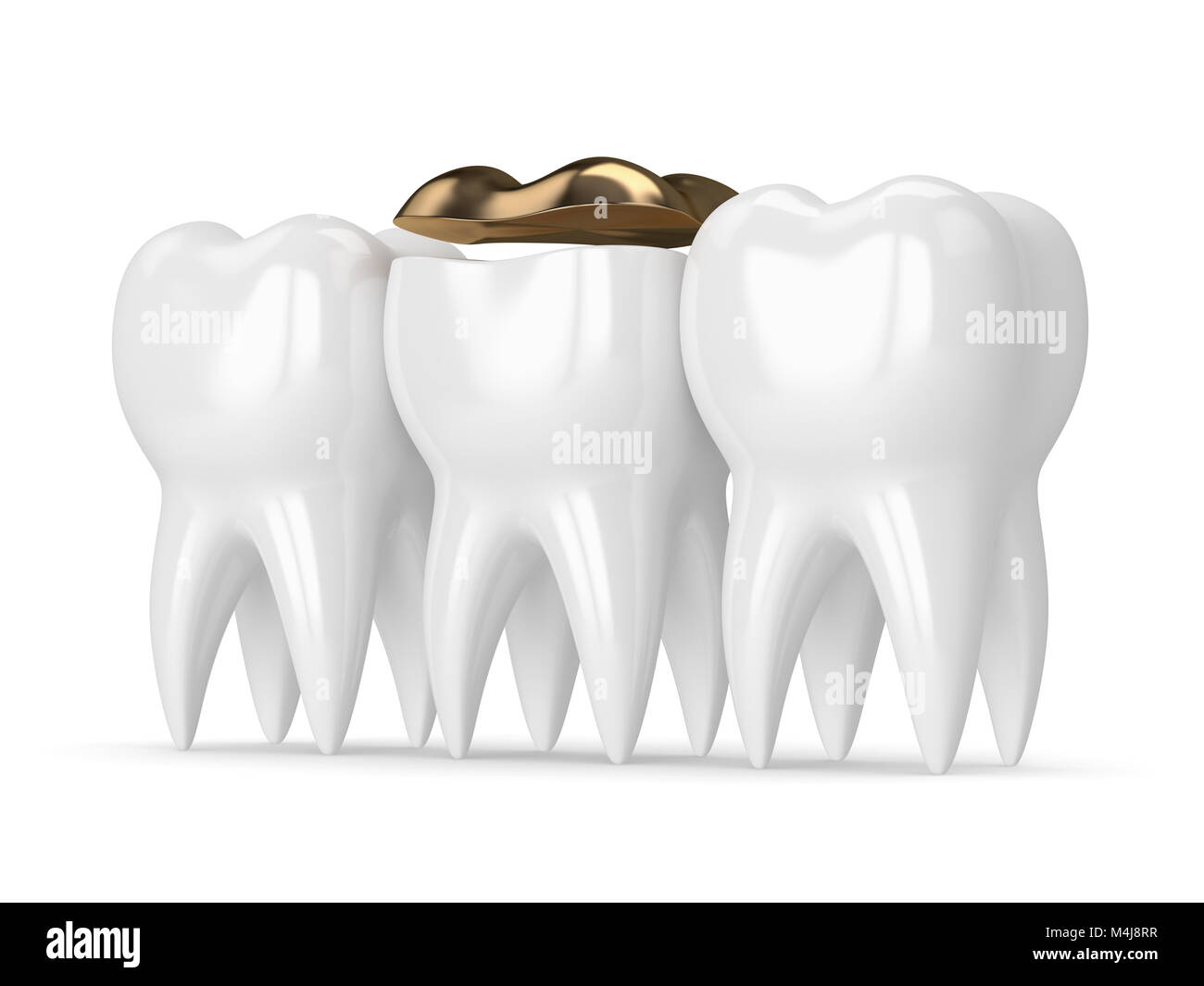 3d render of teeth with dental golden onlay filling over white ...