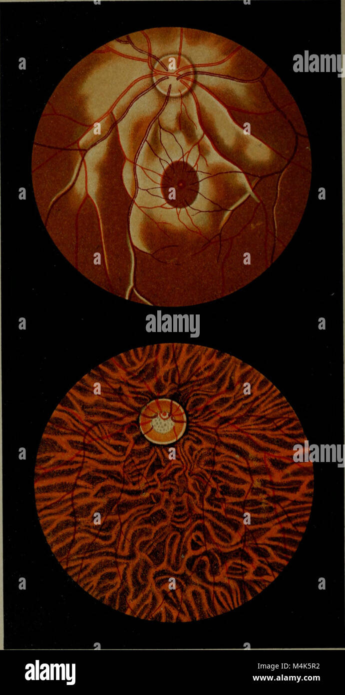 This 1910 atlas provides a comprehensive guide to ophthalmoscopy, the ...
